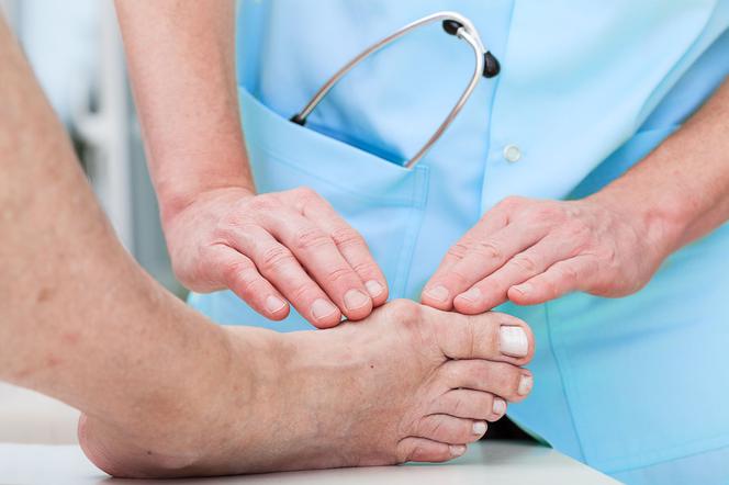 Haluksy - objawy - jak powstają - diagnoza - leczenie | Netlekarz